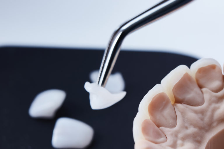 Veneers 101: Can They Be Applied Over Your Existing Teeth?